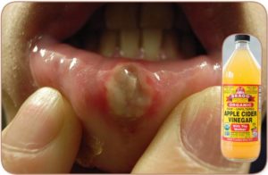 Is apple cider vinegar good for canker sores? - Herbs And Plants For ...